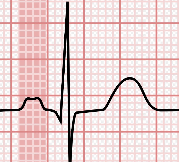 ECG drawing - Buy Three layers of carbonless paper, Two layers of ...