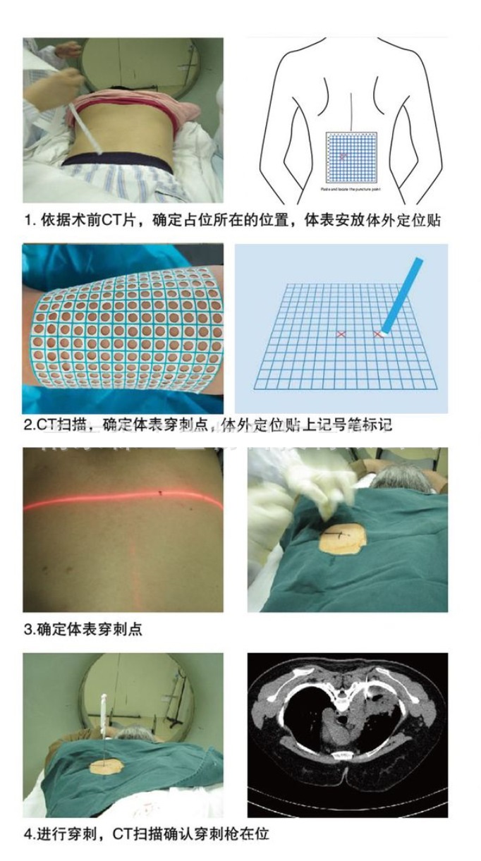Ct Scan Of Body Surface Positioning Sticker Puncture Positioning Sticker Buy Cubierta De Luz